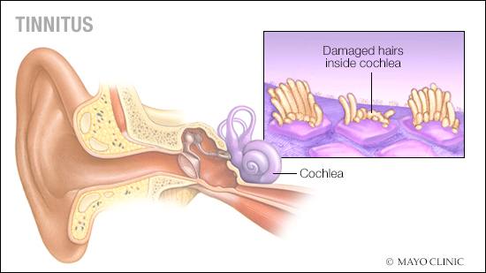 a medical illustration of tinnitus 16X9 - VA Claims Insider
