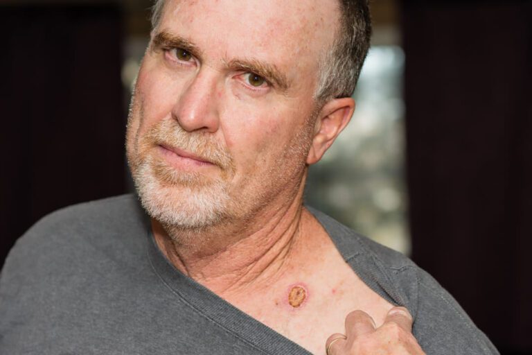 Is There a VA Disability Rating for Skin Conditions?