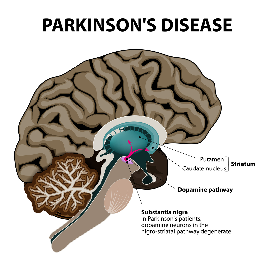Getting a VA Disability Rating for Parkinson's Disease (Ultimate Guide)