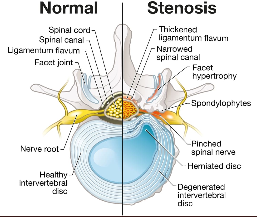 Spinal Stenosis VA Ratings Explained (Ultimate Guide)