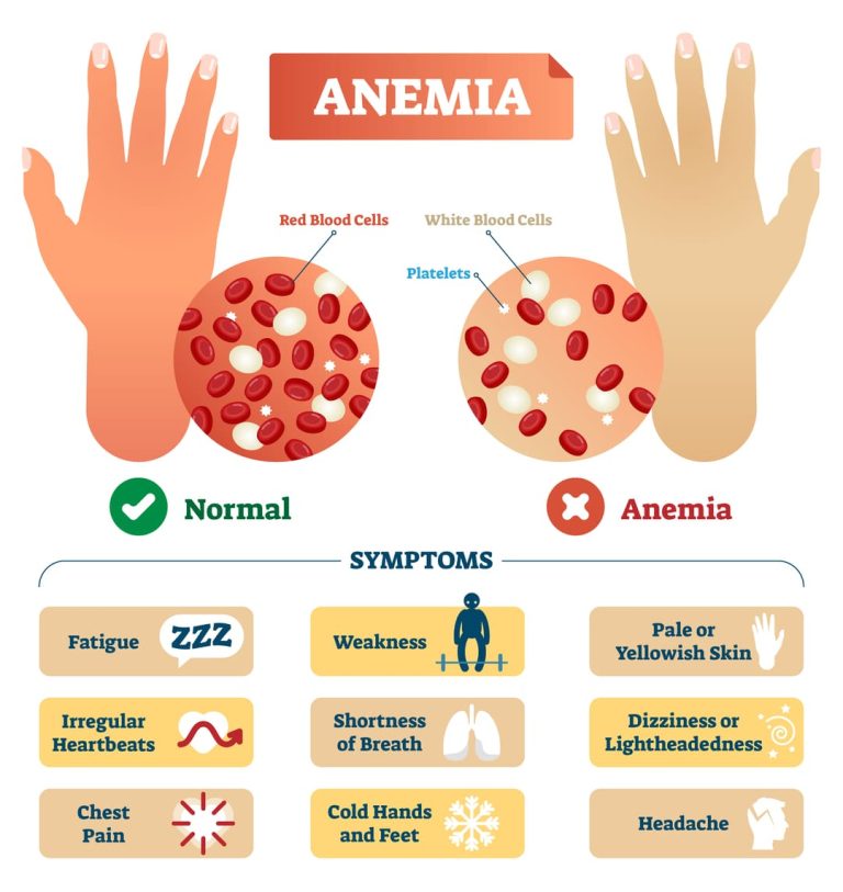 VA Rating For Anemia - Explained!