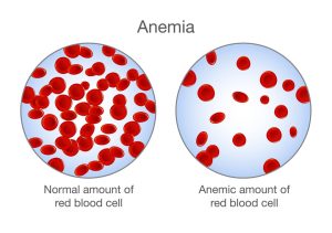VA Rating For Anemia - Explained!