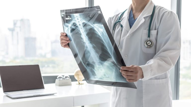 Qualifying for a VA Disability Rating for Pulmonary Fibrosis