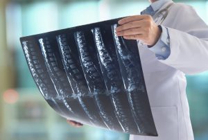 How to Get a VA Disability Rating For Spinal Fusion