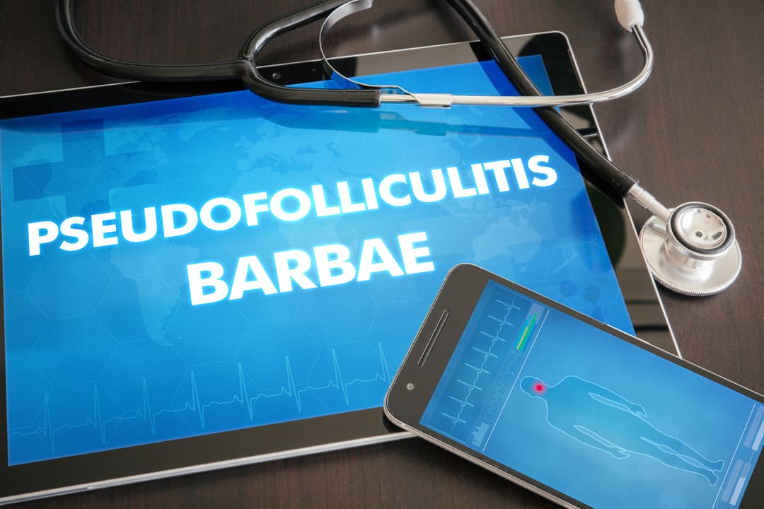 Pseudofolliculitis Barbae VA Ratings Explained!