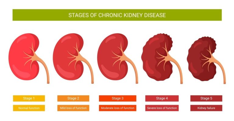 VA Rating for Kidney Disease (The Ultimate Guide)
