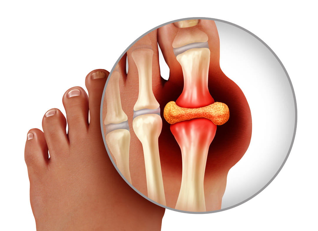 Guide to a VA Rating for Gout