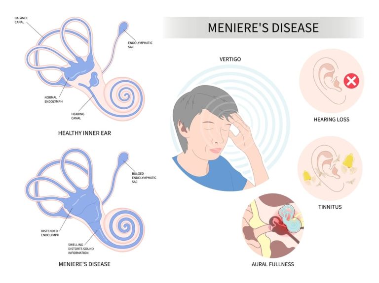 VA Rating for Vertigo and Meniere’s Disease (Ultimate Guide)