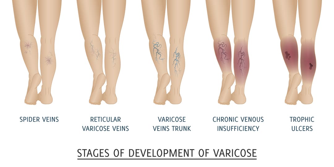 How to Get a VA Rating for Varicose Veins