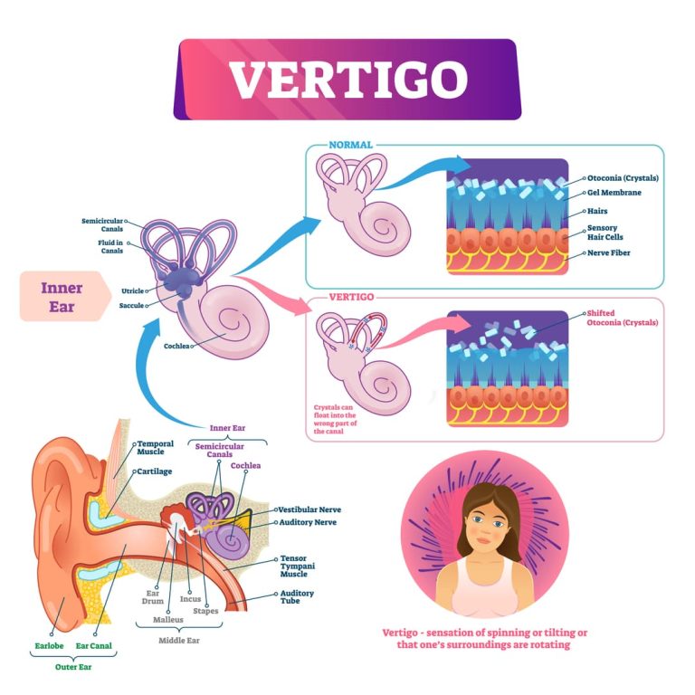 VA Rating for Vertigo and Meniere’s Disease (Ultimate Guide)