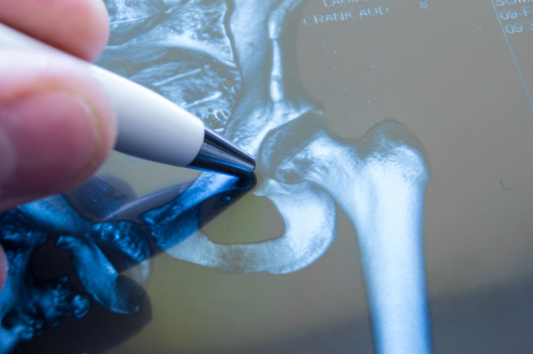 Hip Pain VA Rating Guide