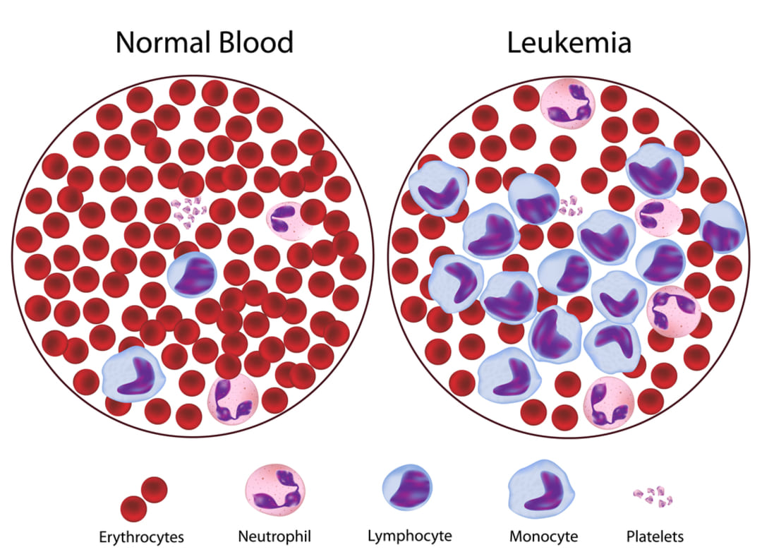 VA Disability Rating for Chronic Lymphocytic Leukemia