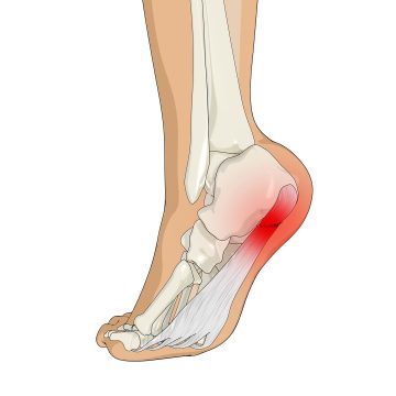 What Foot Problems Qualify for VA Disability? 8 Common Conditions