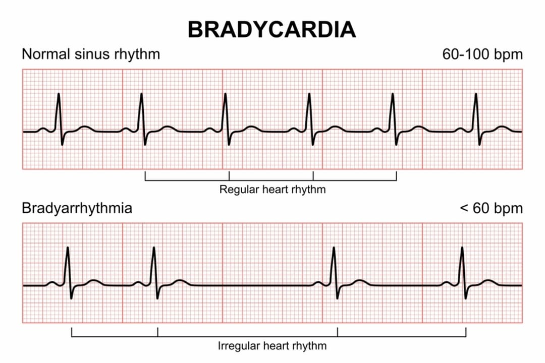 How to Get a Bradycardia VA Disability Rating